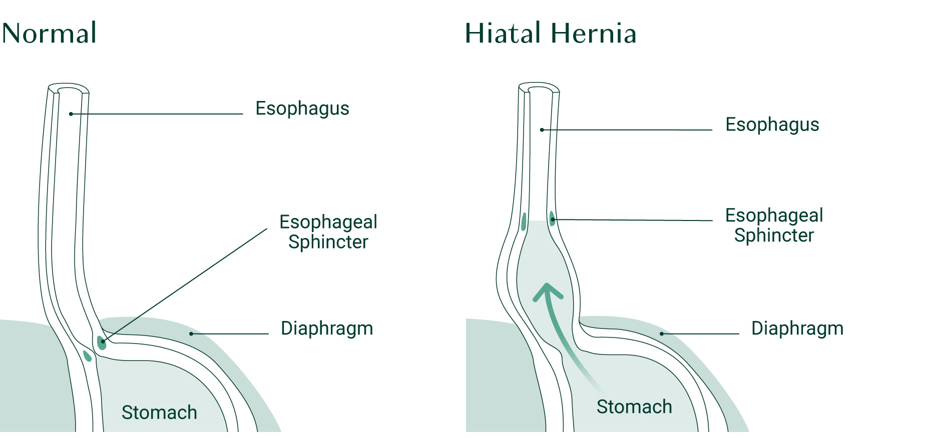 How to Naturally Combat GERD (Acid Reflux) | AlgaeCal