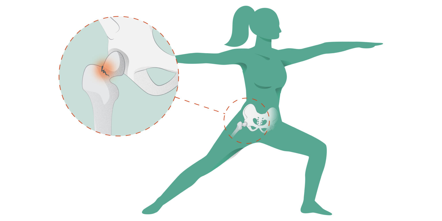 Femoral Neck Exercises | AlgaeCal