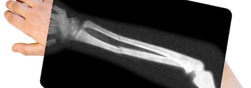 Understanding Bone Fractures Understanding Bone Fractures